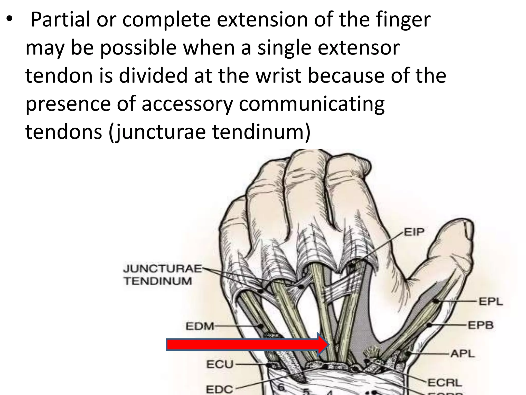 Extensor tendon injuries hand | PPTX