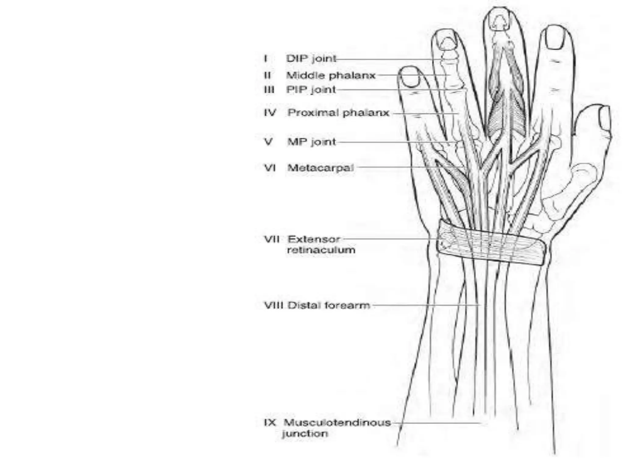 Extensor tendon injuries hand | PPTX