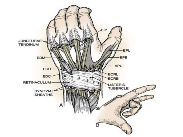 Extensor tendon injuries hand | PPTX | Death, Injury, or Military ...