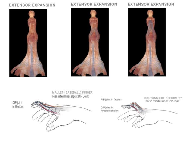 Extensor tendon injuries hand | PPTX | Death, Injury, or Military ...
