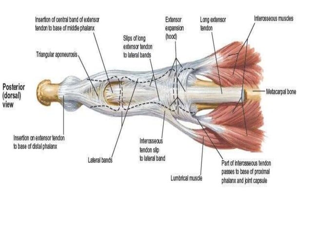 Extensor tendon injuries hand | PPTX | Death, Injury, or Military ...
