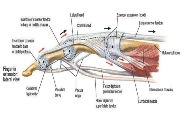 Extensor tendon injuries hand | PPTX | Death, Injury, or Military ...