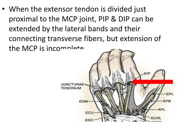 Extensor tendon injuries hand | PPTX | Death, Injury, or Military ...