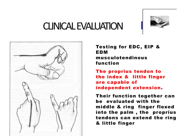 Extensor tendon injuries hand | PPTX | Death, Injury, or Military ...