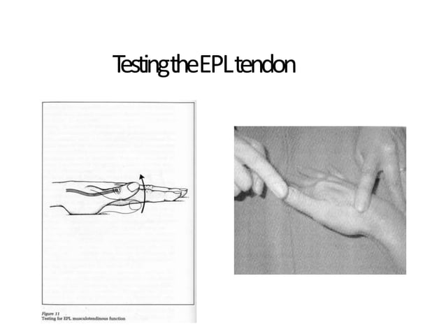 Extensor tendon injuries hand | PPTX | Death, Injury, or Military ...