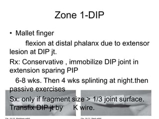 Extensor tendon injuries hand | PPTX