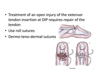 Extensor tendon injuries hand | PPTX