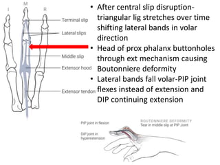 Extensor tendon injuries hand | PPTX
