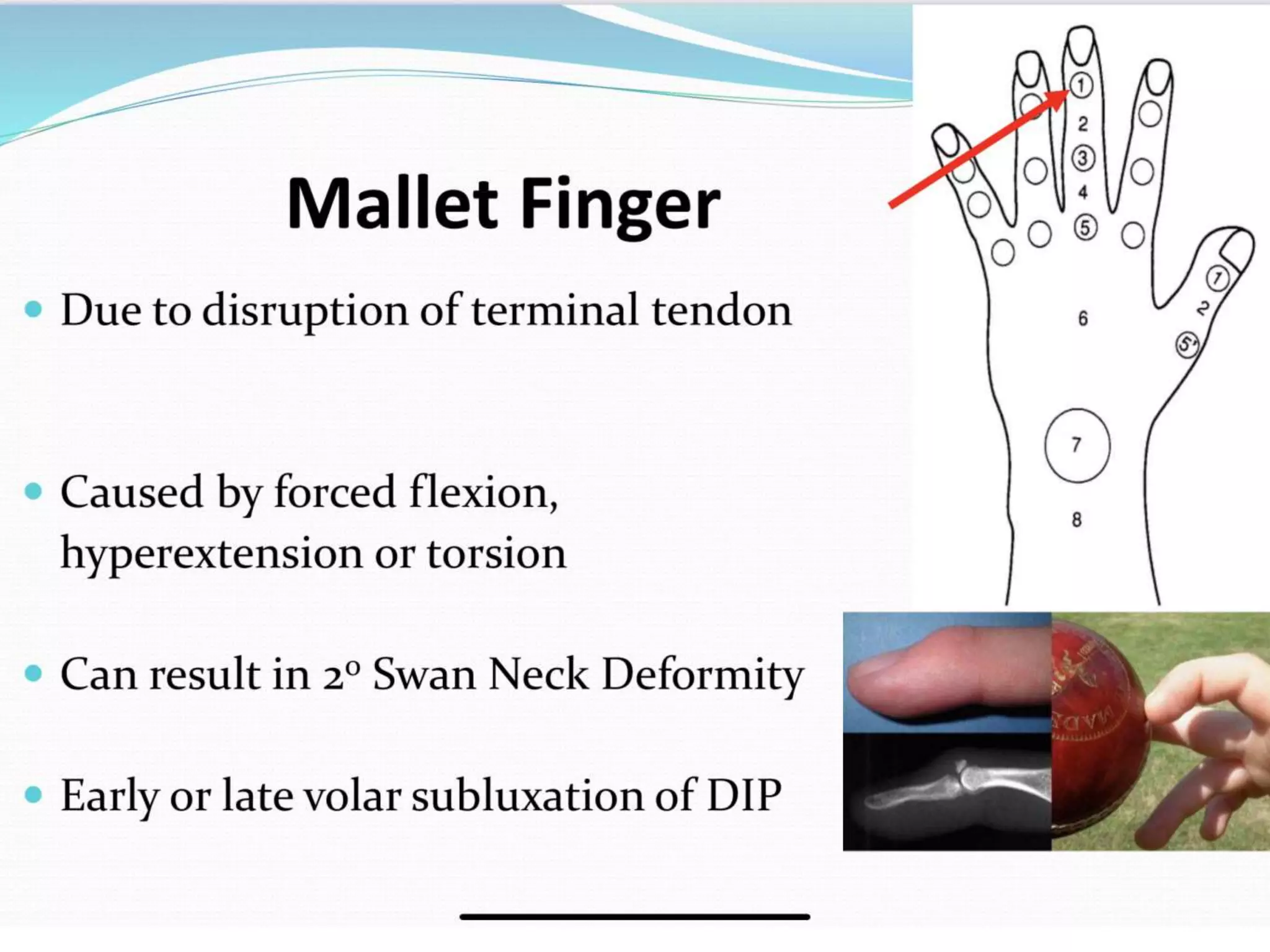 Extensor tendon injuries | PPTX