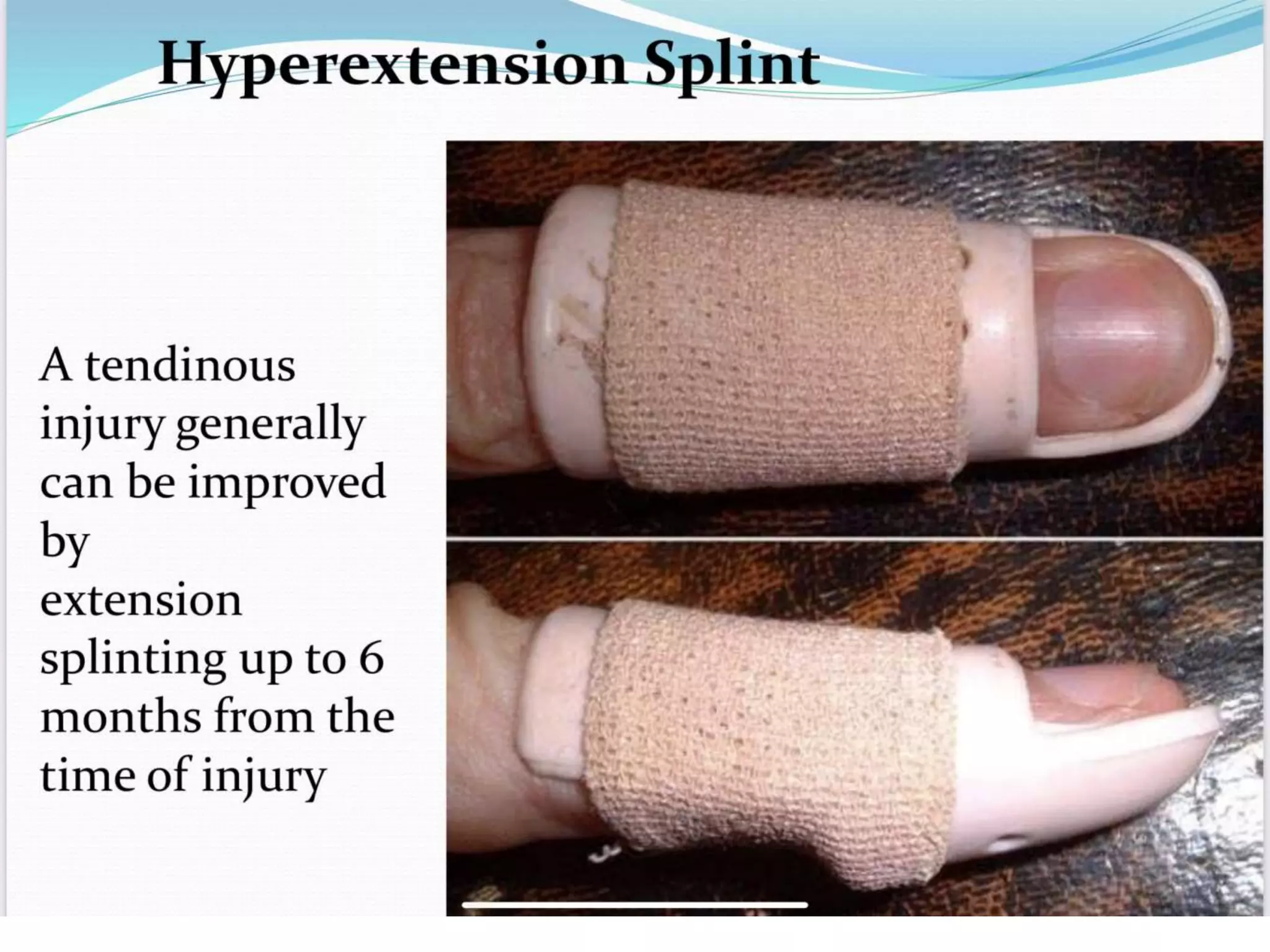 Extensor tendon injuries | PPT