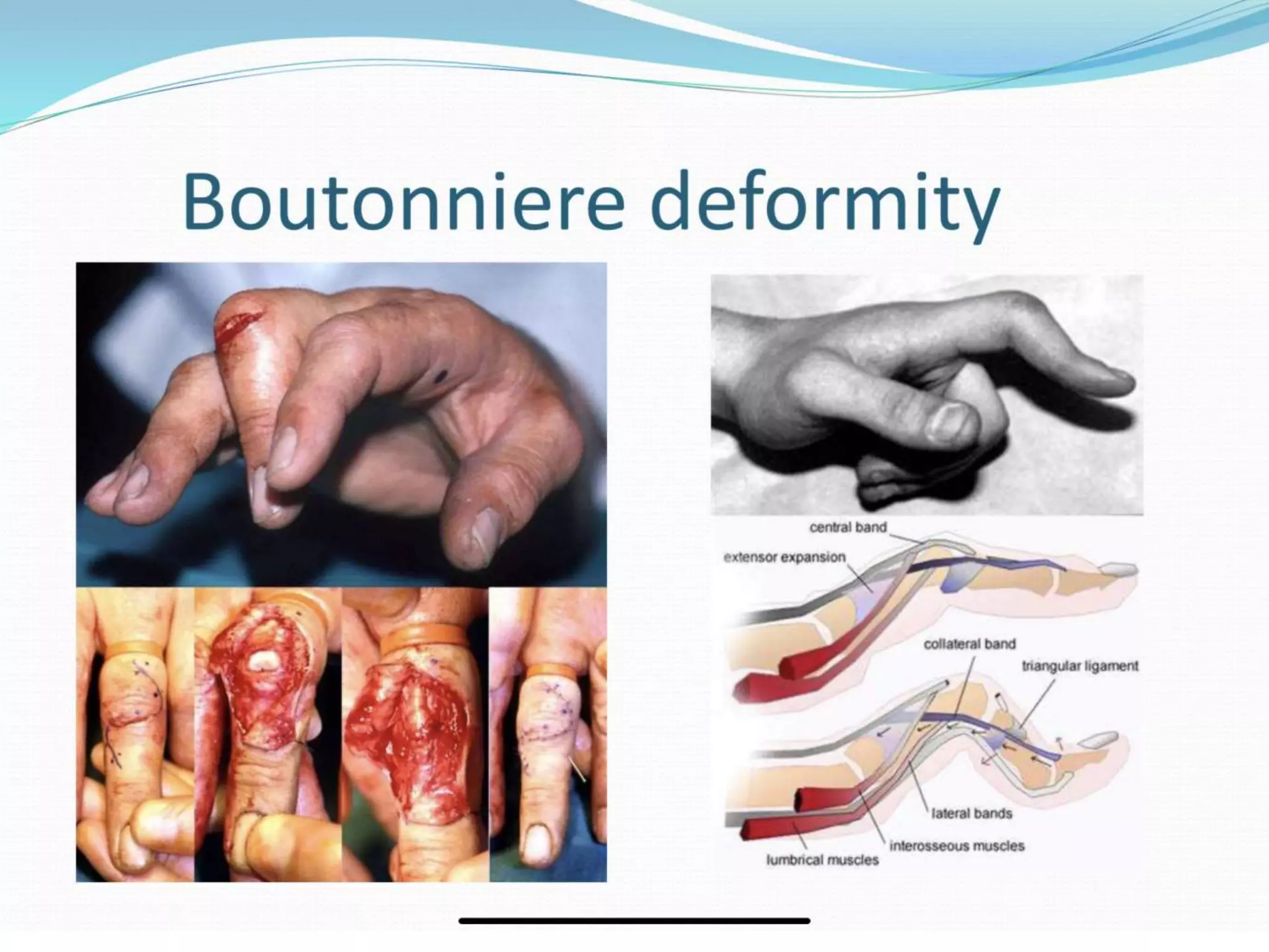 Extensor tendon injuries | PPTX