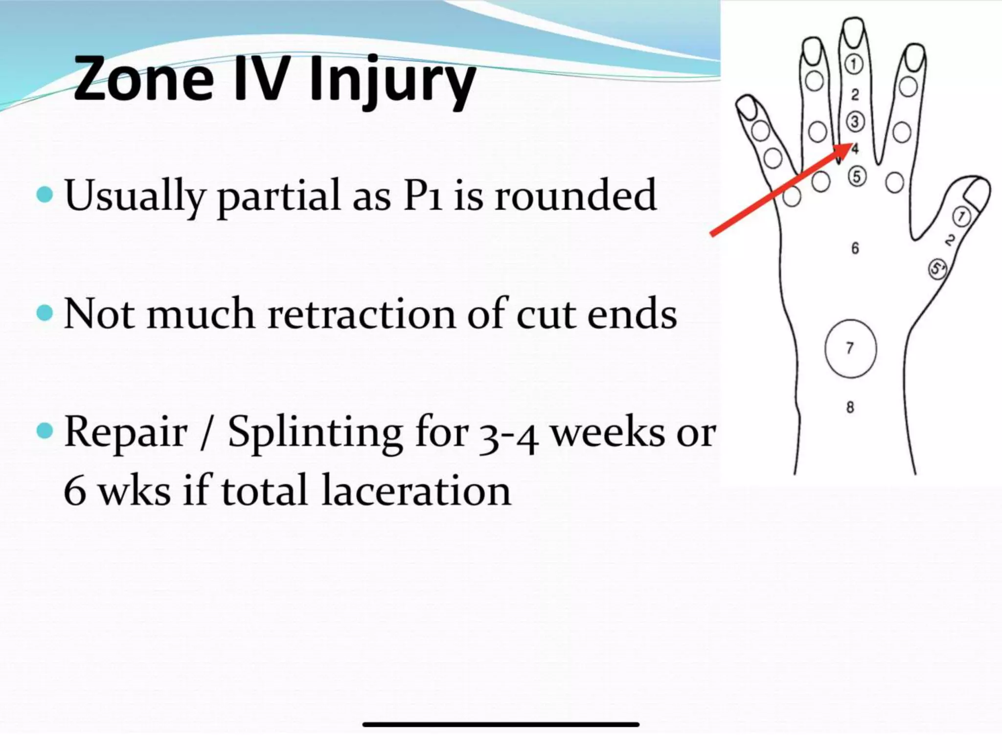 Extensor tendon injuries | PPTX