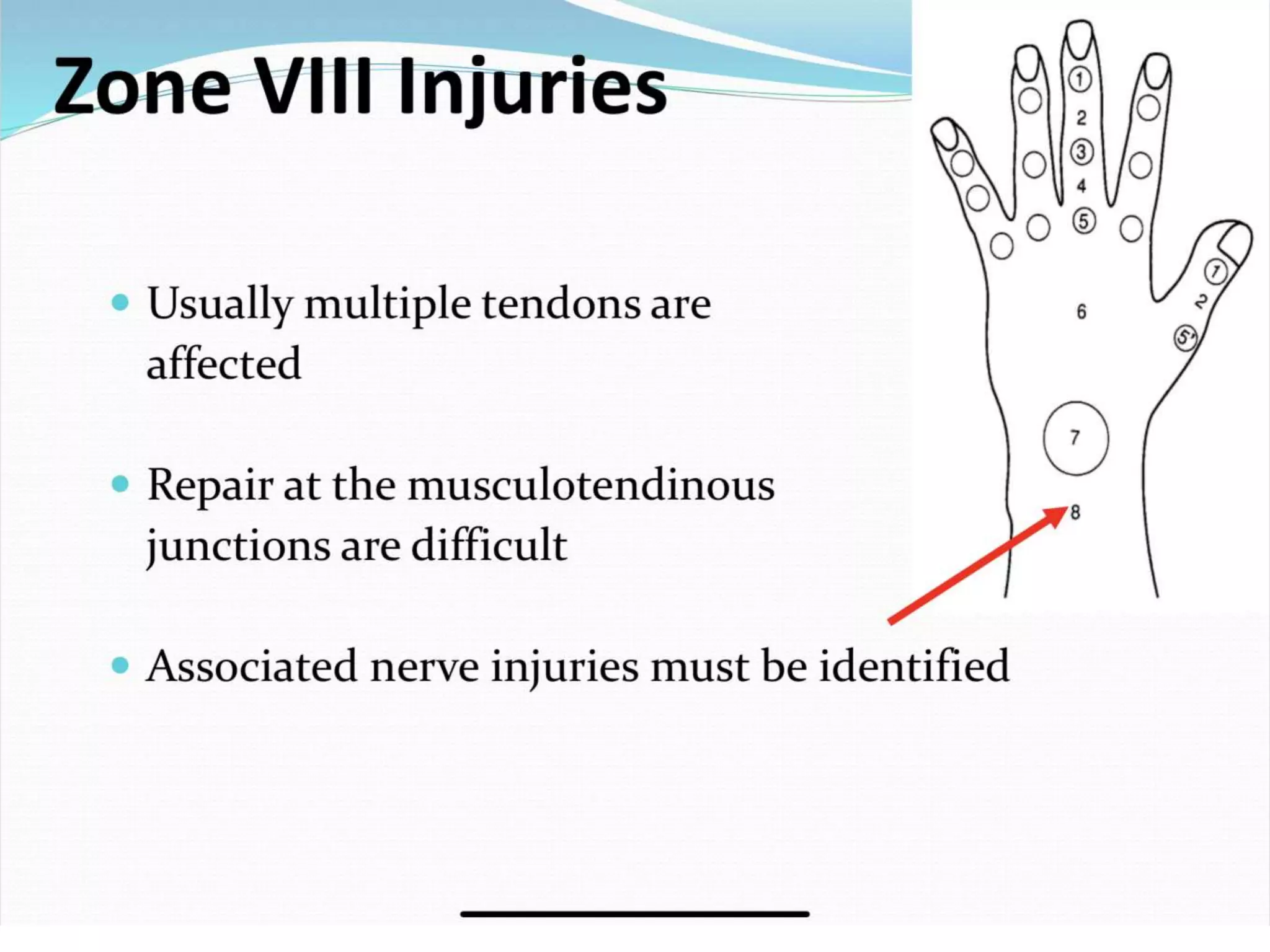 Extensor tendon injuries | PPTX