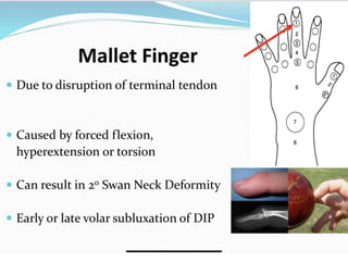 Extensor tendon injuries | PPT
