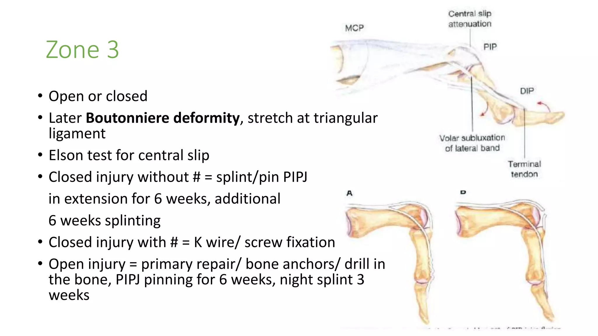 Extensor tendon injury | PPTX