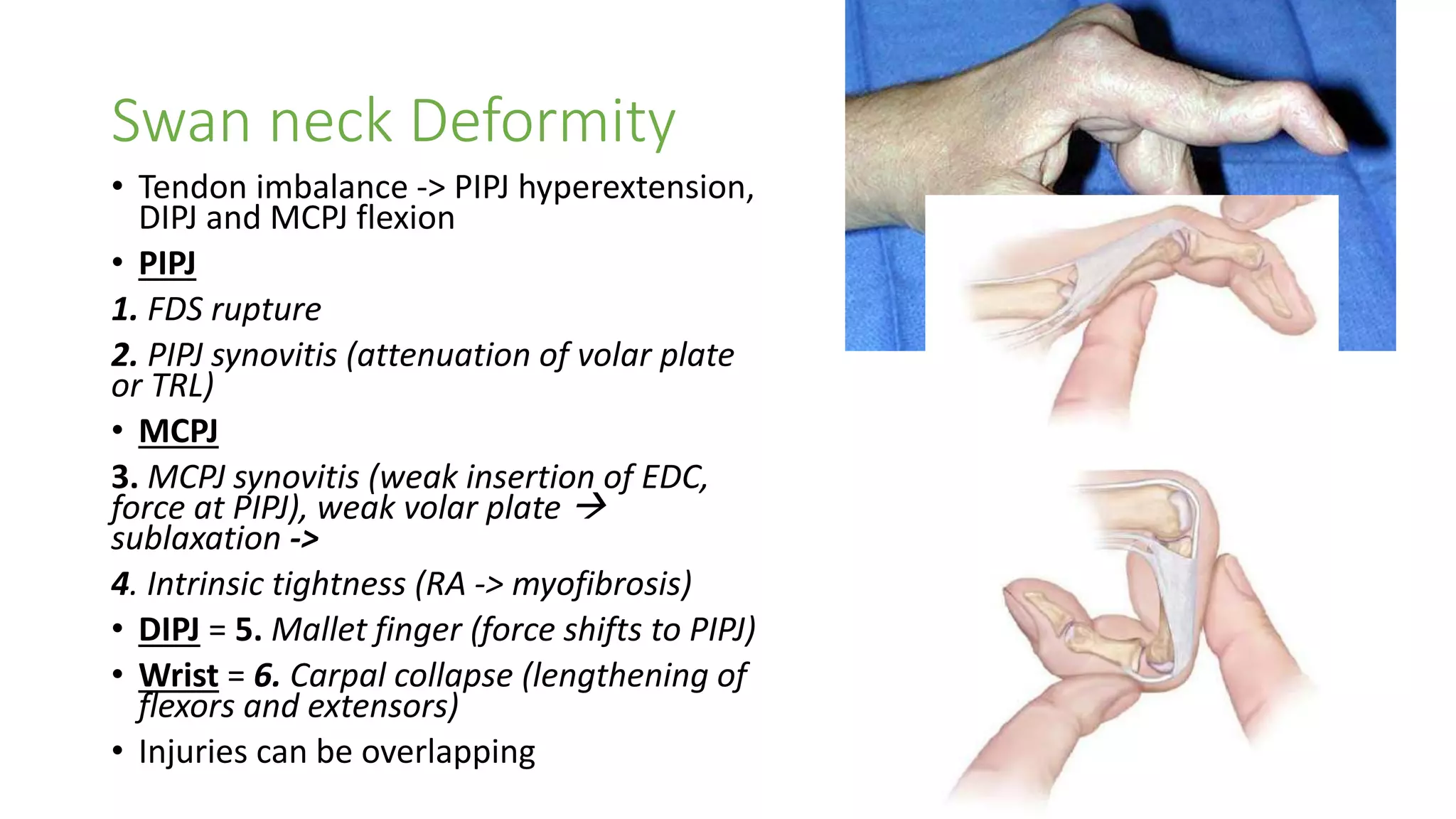 Extensor tendon injury | PPTX