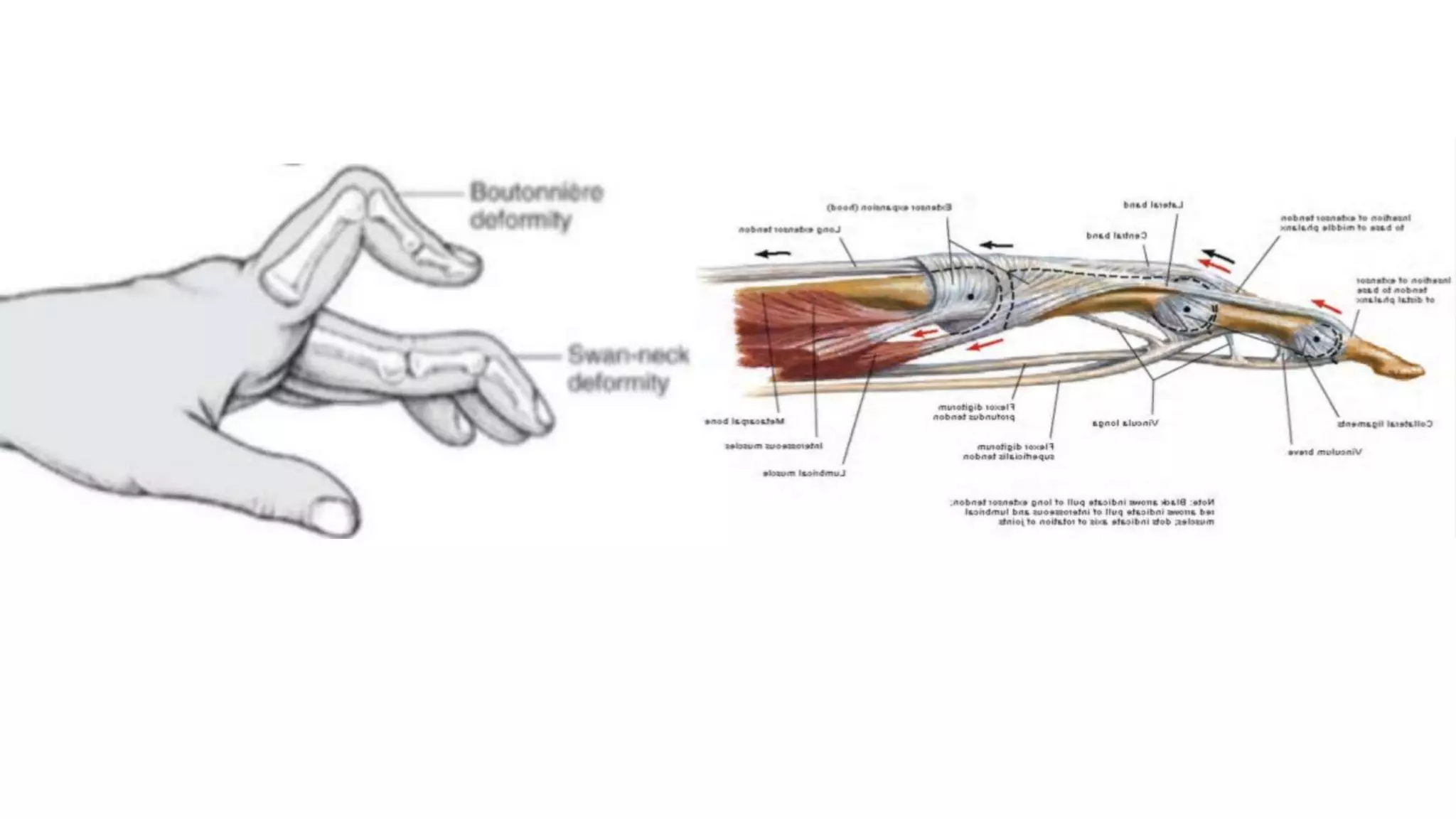 Extensor tendon injury | PPTX | Death, Injury, or Military Conflict ...