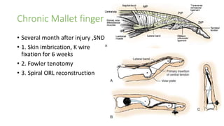 Extensor tendon injury | PPTX