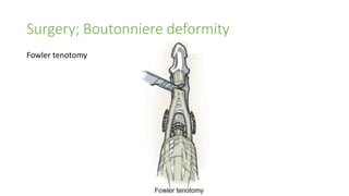 Extensor tendon injury | PPTX