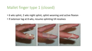 Extensor tendon injury | PPTX