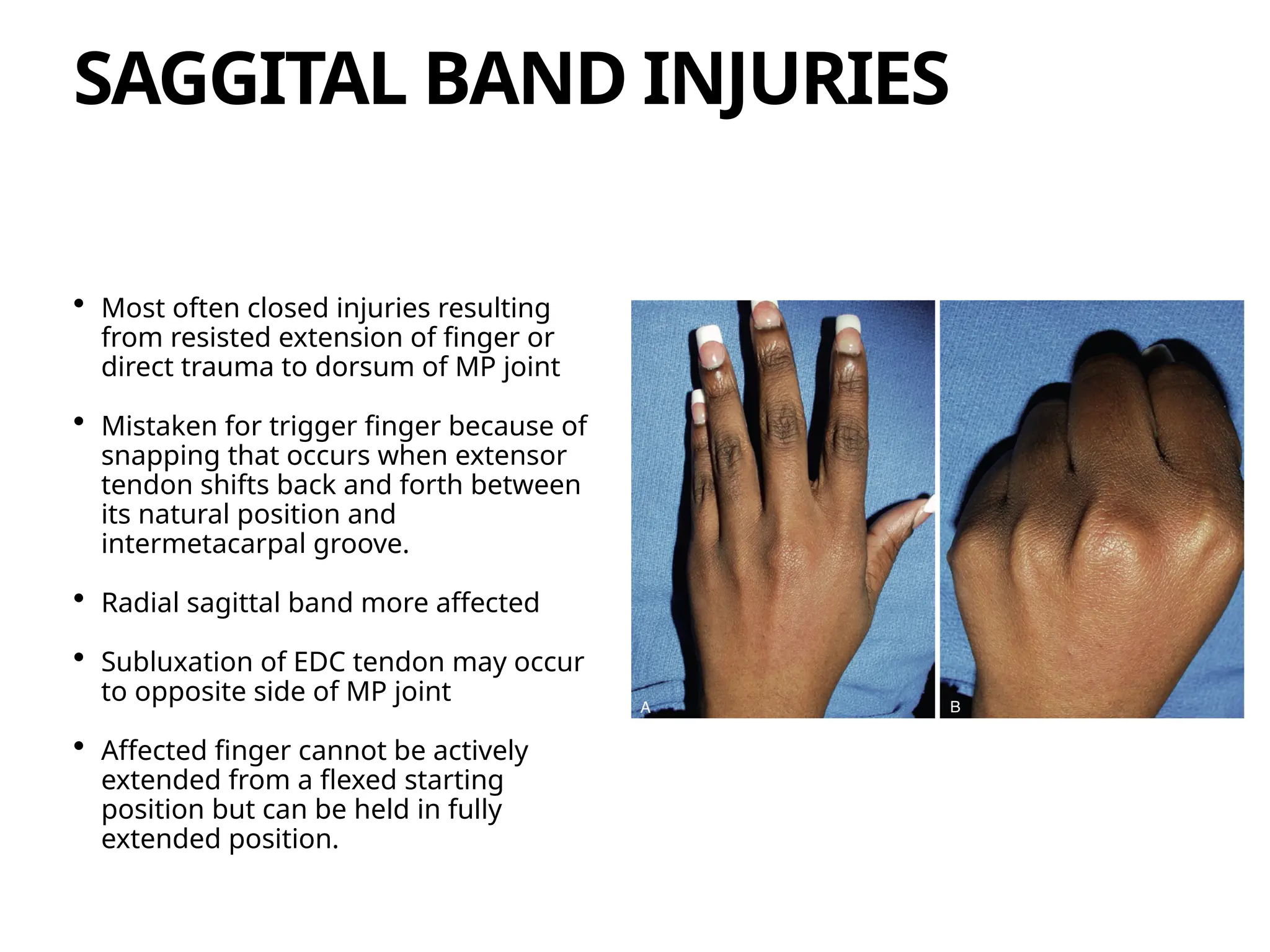 Extensor tendon anatomy, injury and its mangement pptx | PPTX