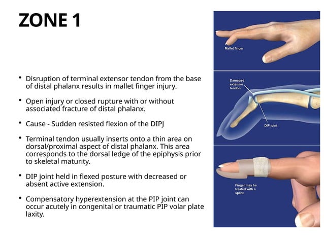 Extensor tendon anatomy, injury and its mangement pptx | PPTX | Death ...
