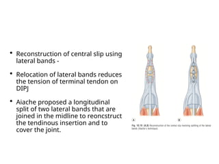 Extensor tendon anatomy, injury and its mangement pptx | PPTX