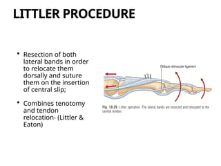 Extensor tendon anatomy, injury and its mangement pptx | PPTX