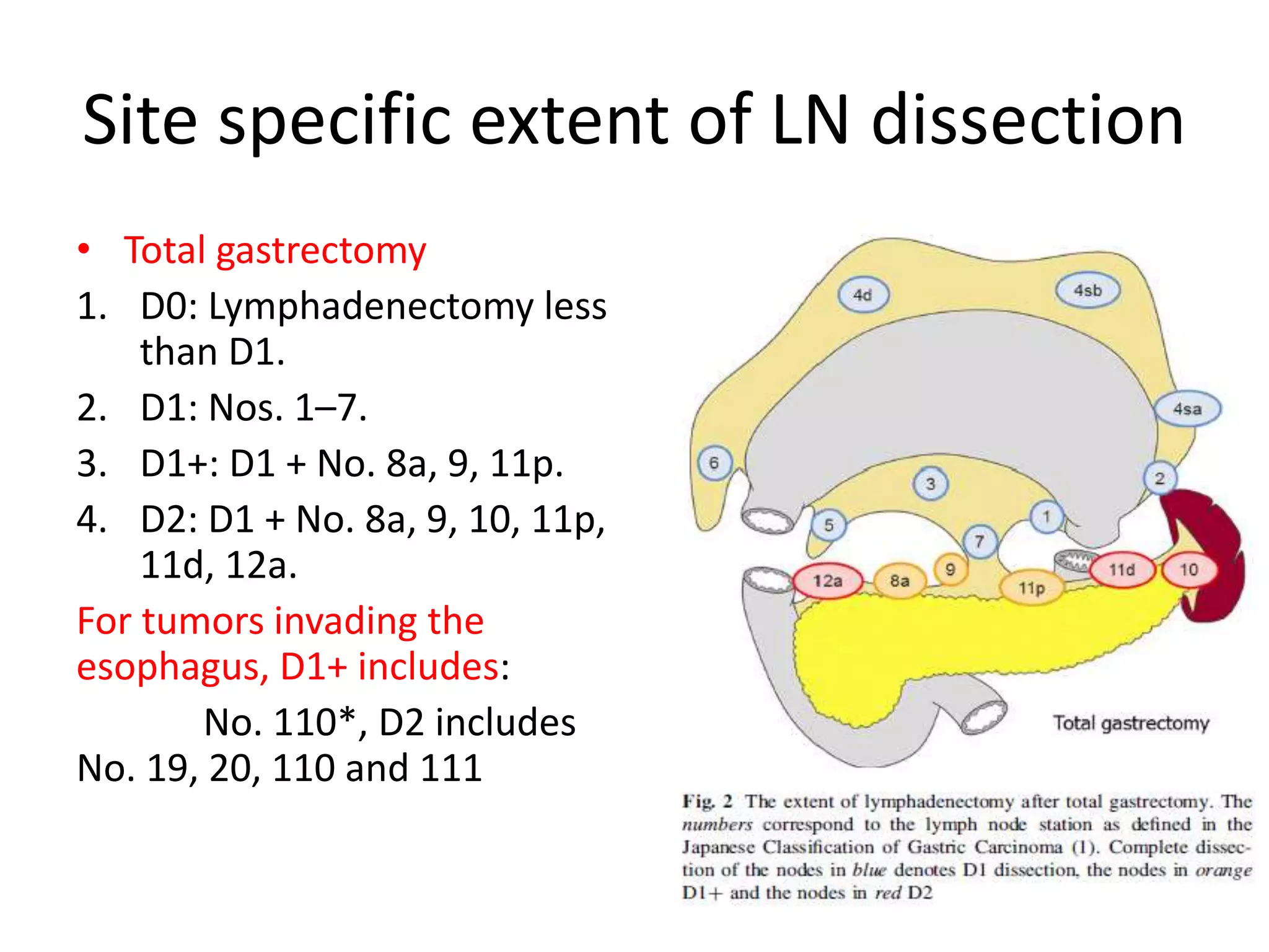 Extent of lymphadenectomy in carcinoma of stomach | PPTX