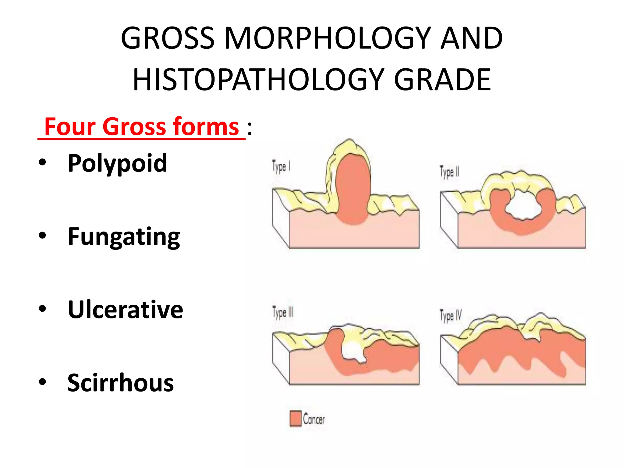 Extent of lymphadenectomy in carcinoma of stomach | PPTX