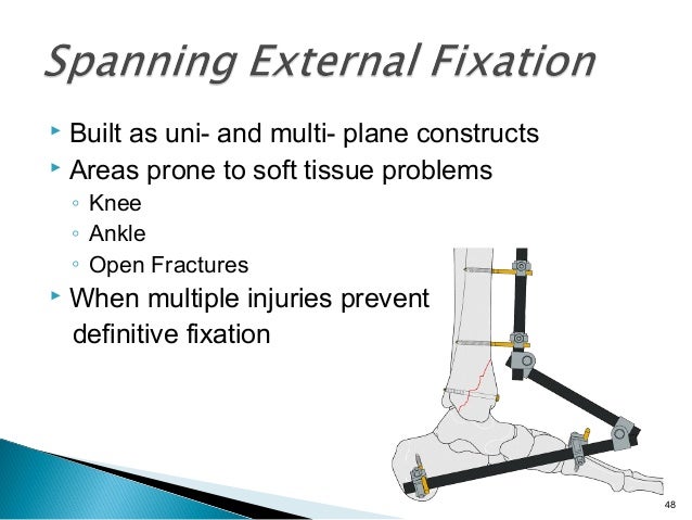External fixator