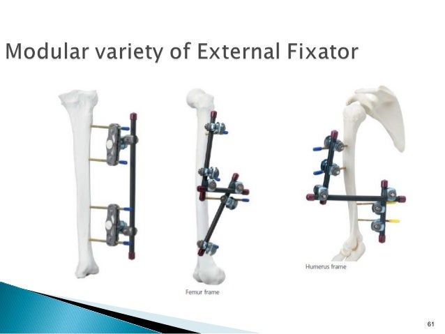 External fixator