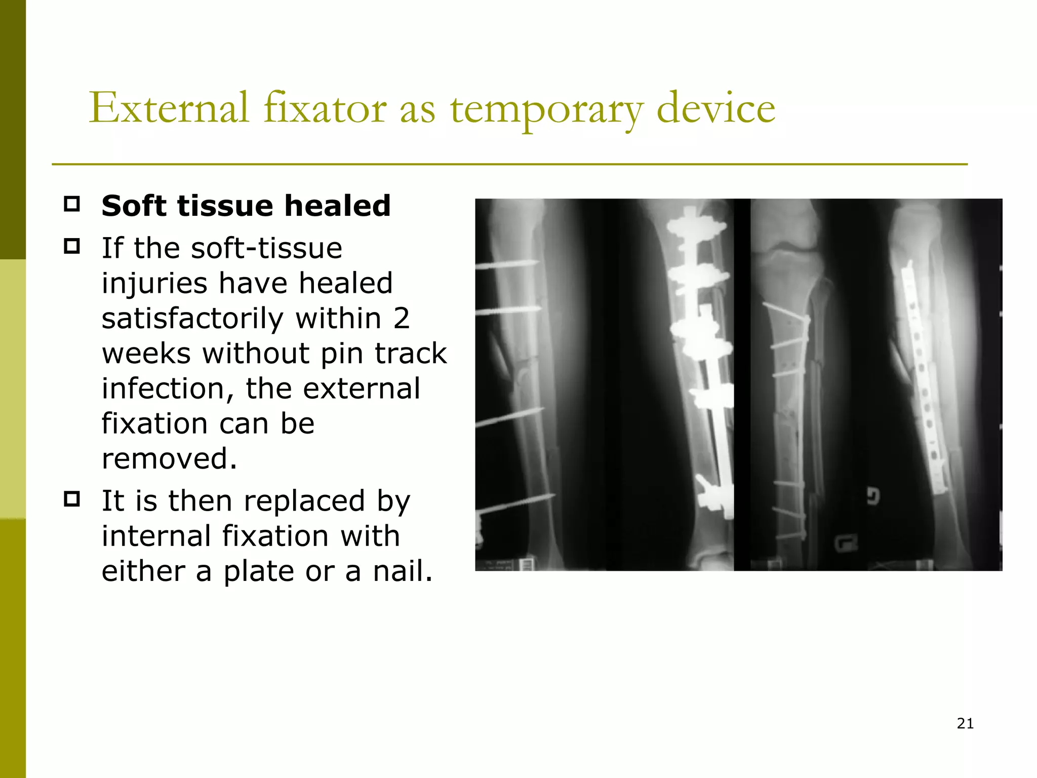External fixator | PPT