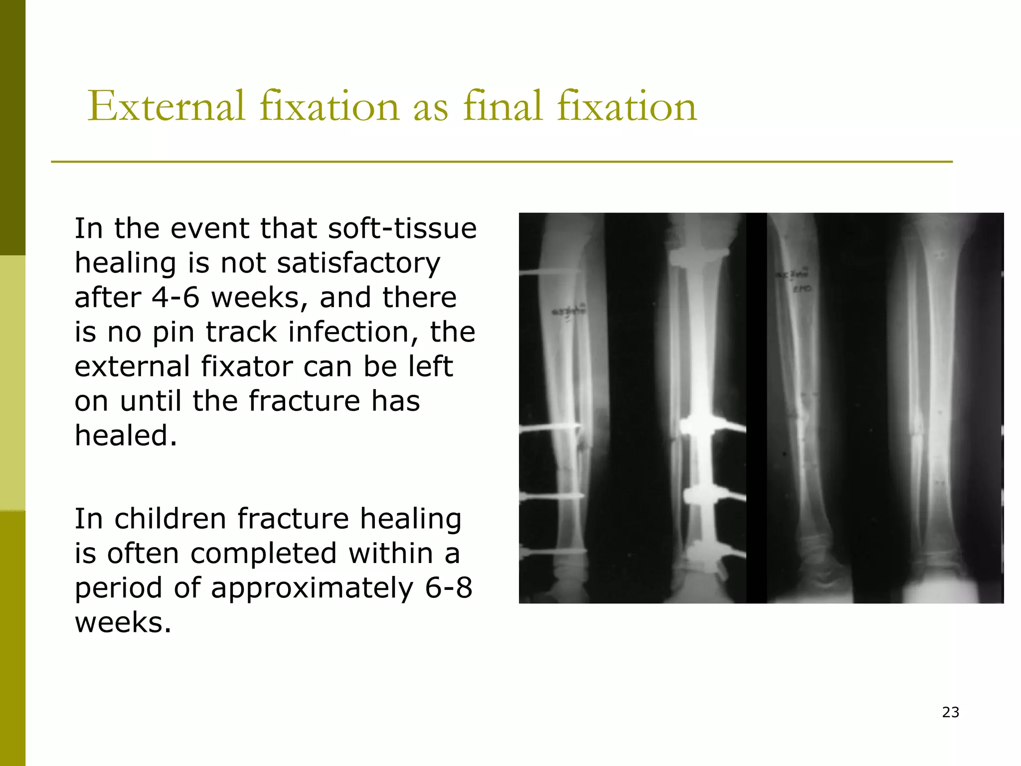 External fixator | PPT