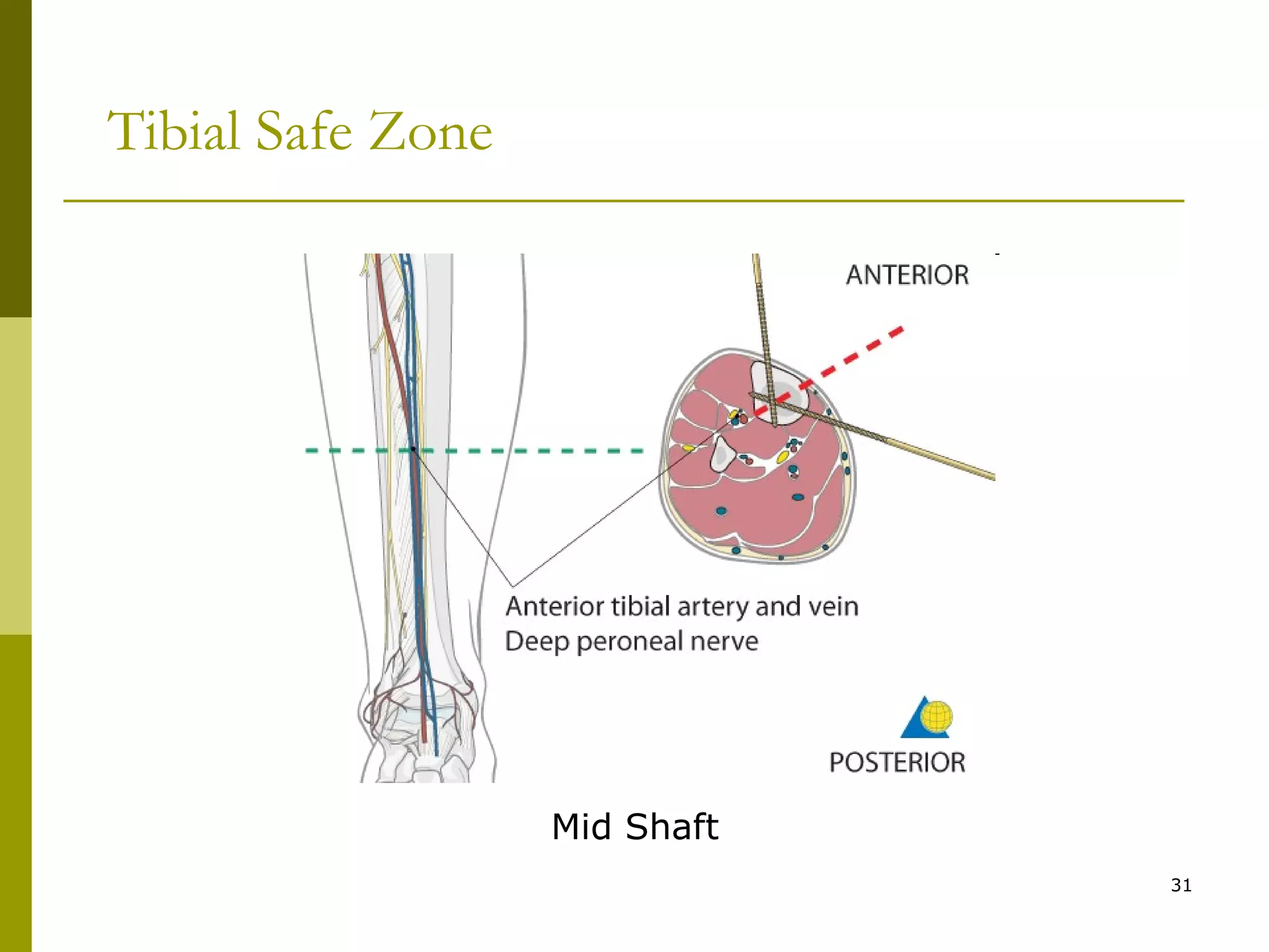 External fixator | PPT