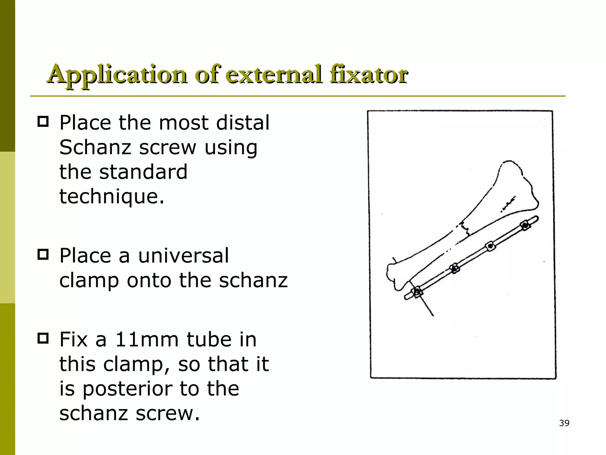 External fixator | PPT