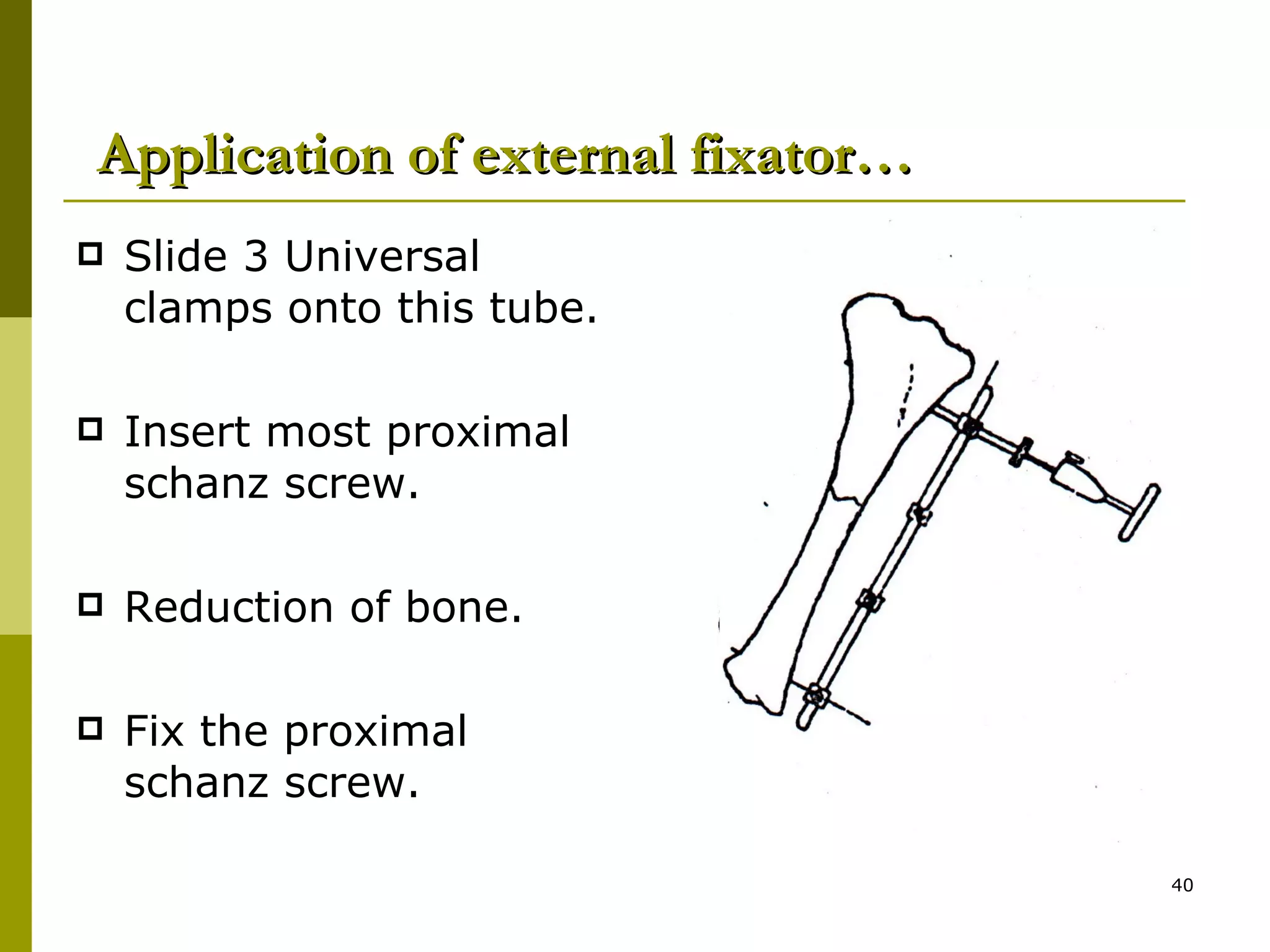 External fixator | PPT