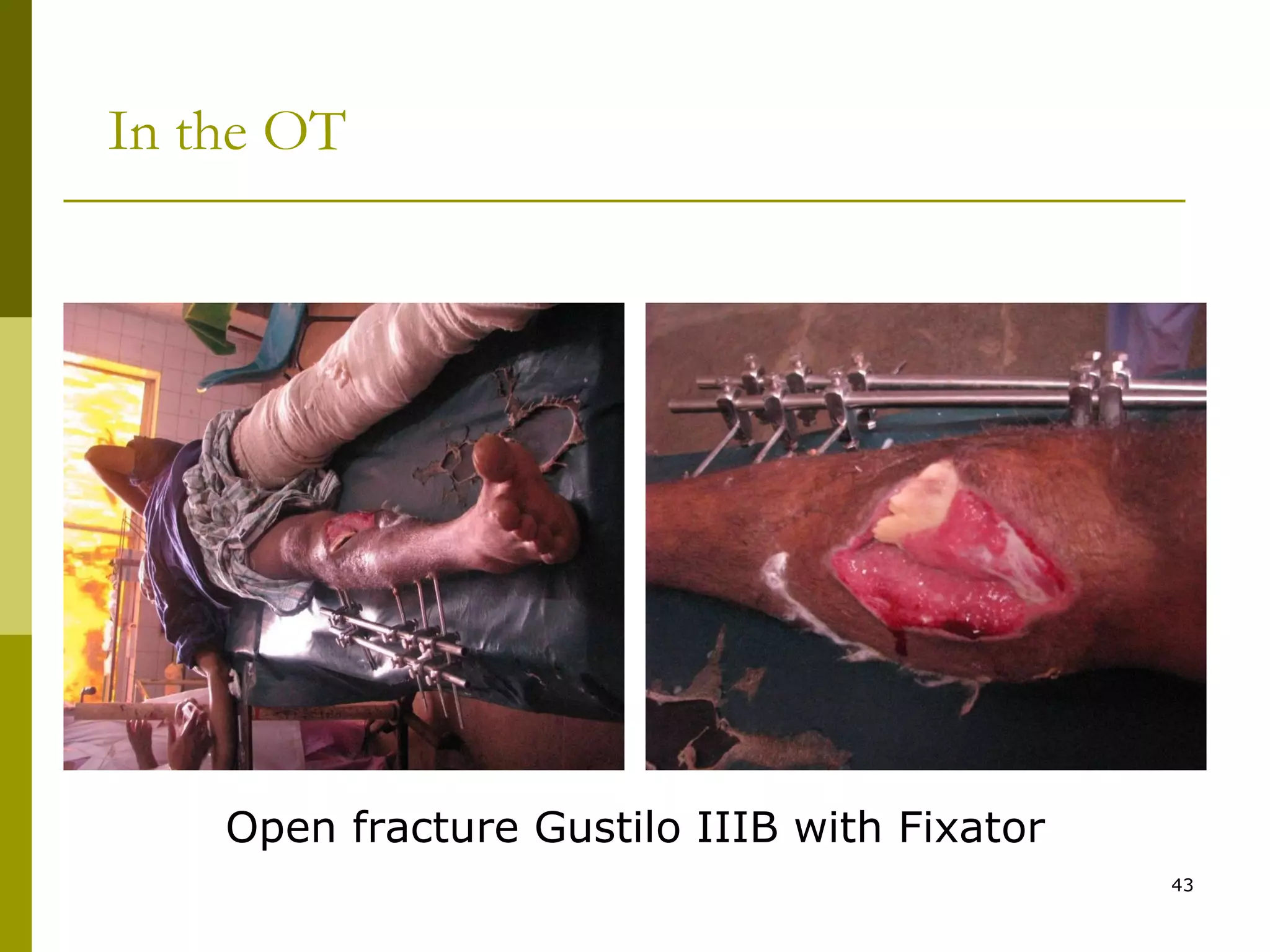 External fixator | PPT