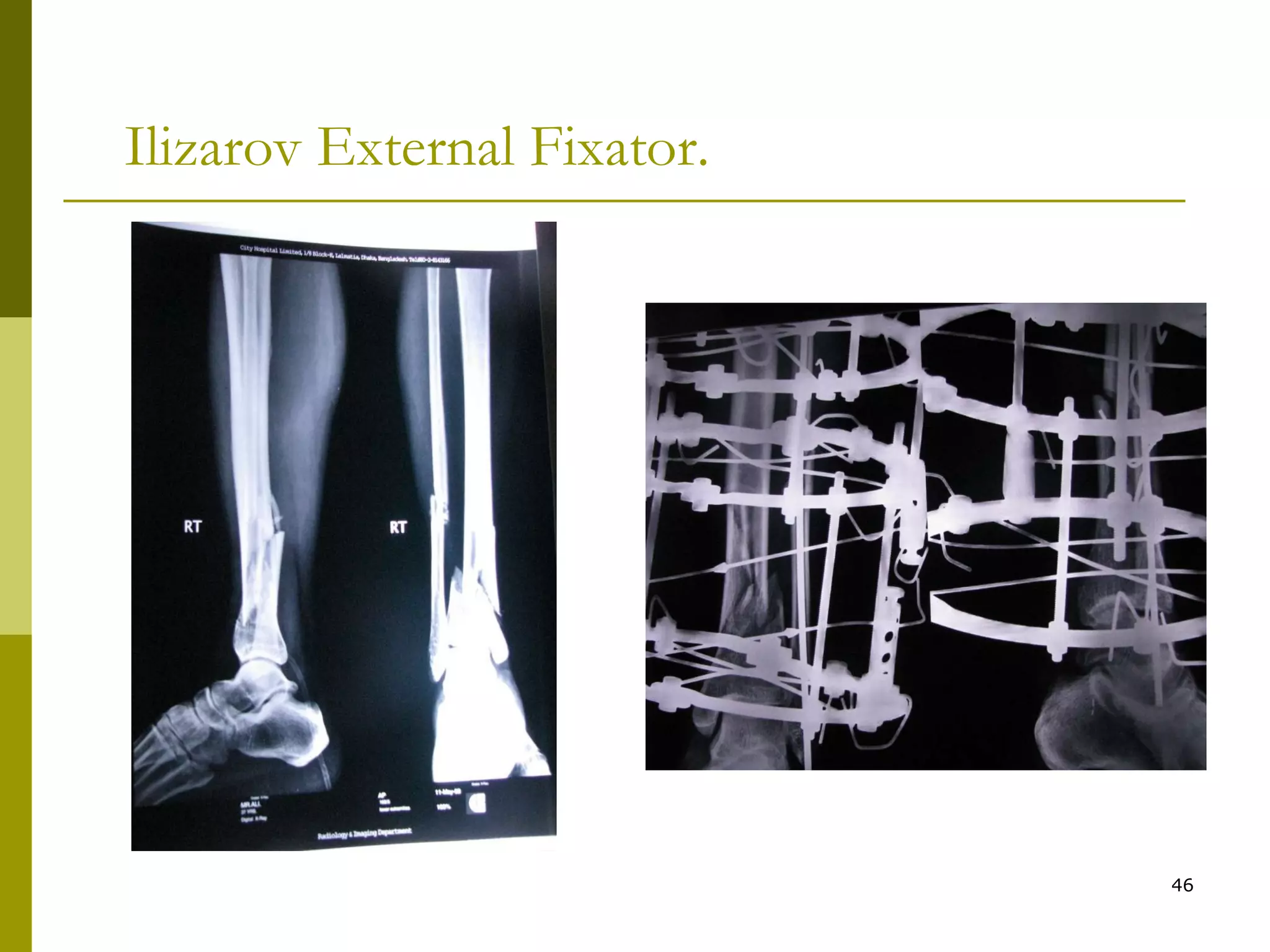 External fixator | PPT