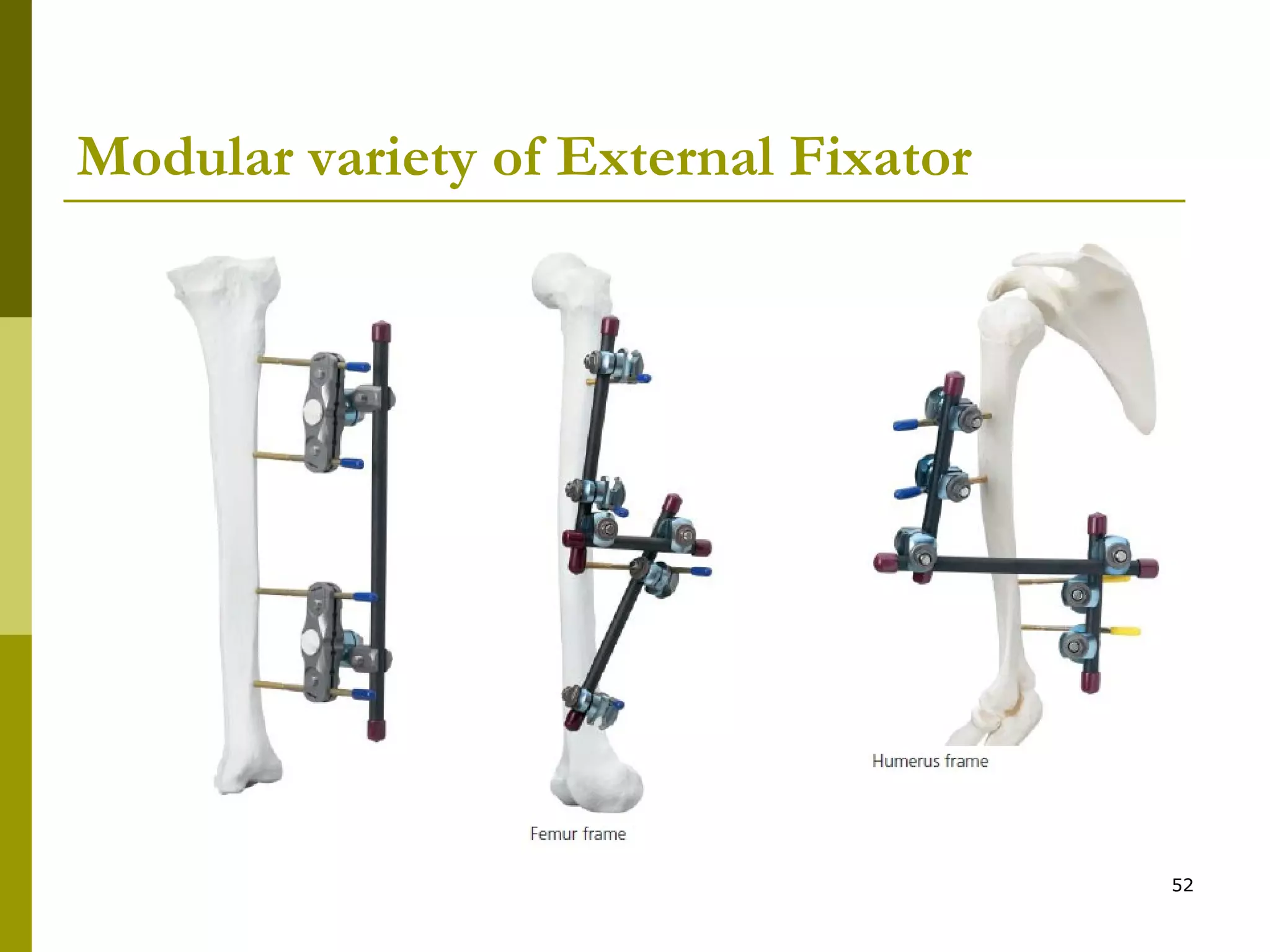 External fixator | PPT