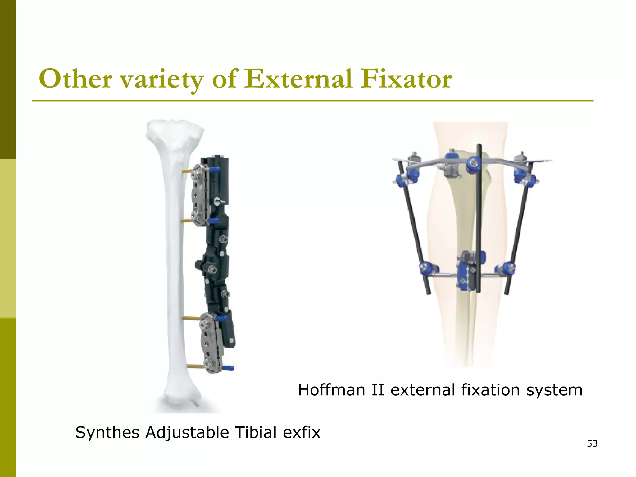 External fixator | PPT