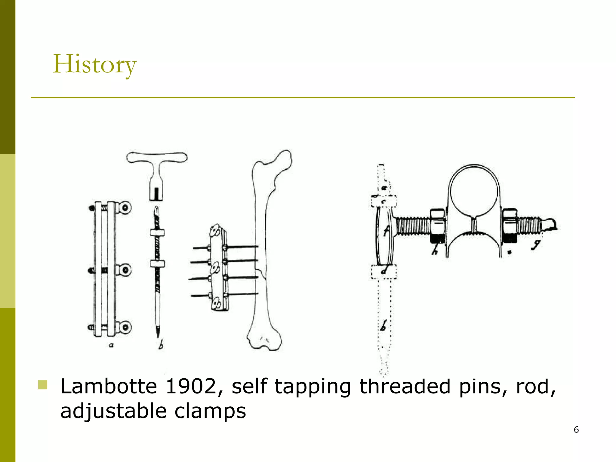 External fixator | PPT