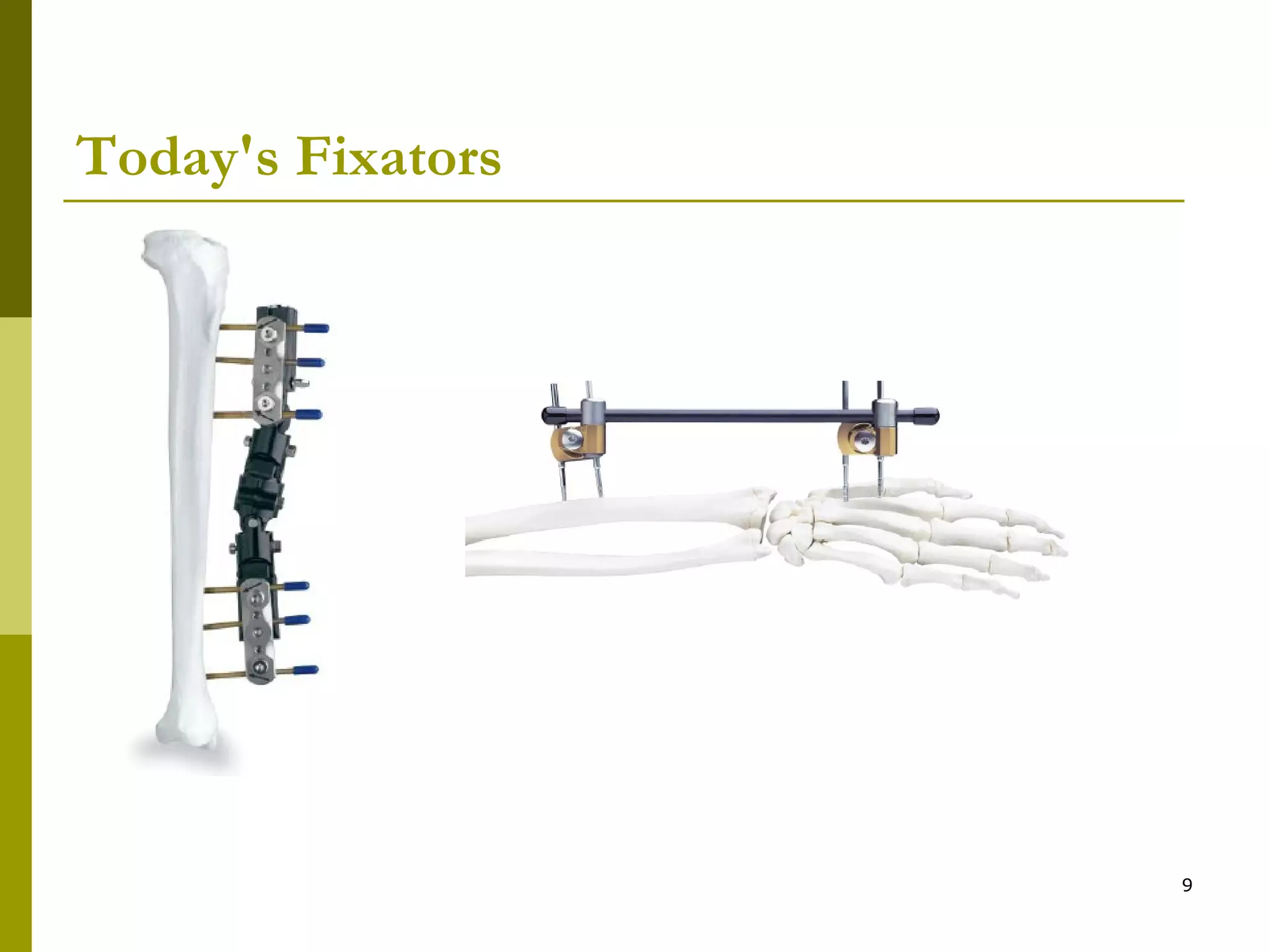 External fixator | PPT