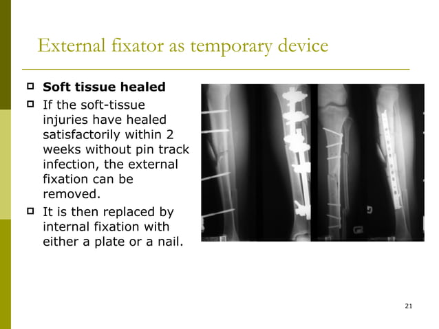 External fixator | PPT