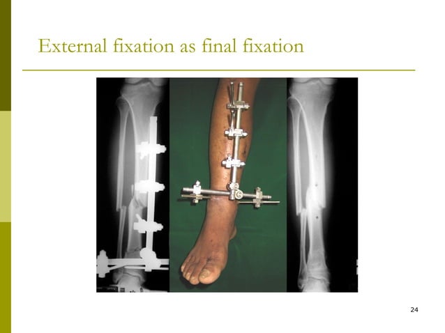 External fixator | PPT