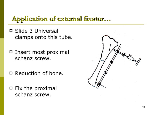External fixator | PPT