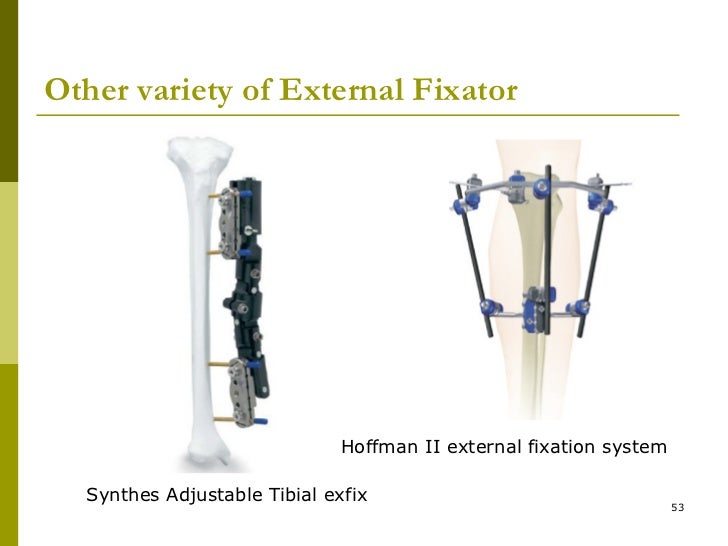 External fixator
