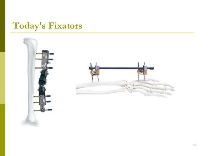 External fixator