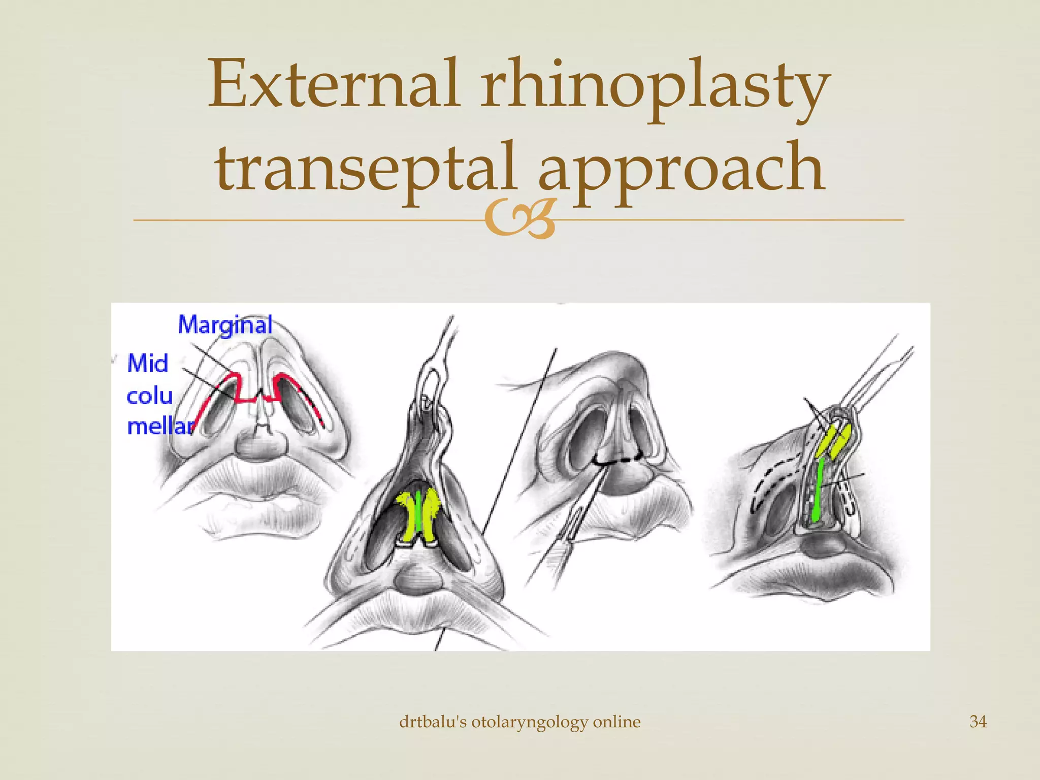 External approaches to sinus surgery | PDF