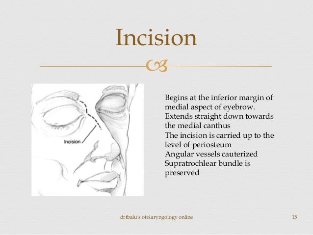 External approaches to sinus surgery